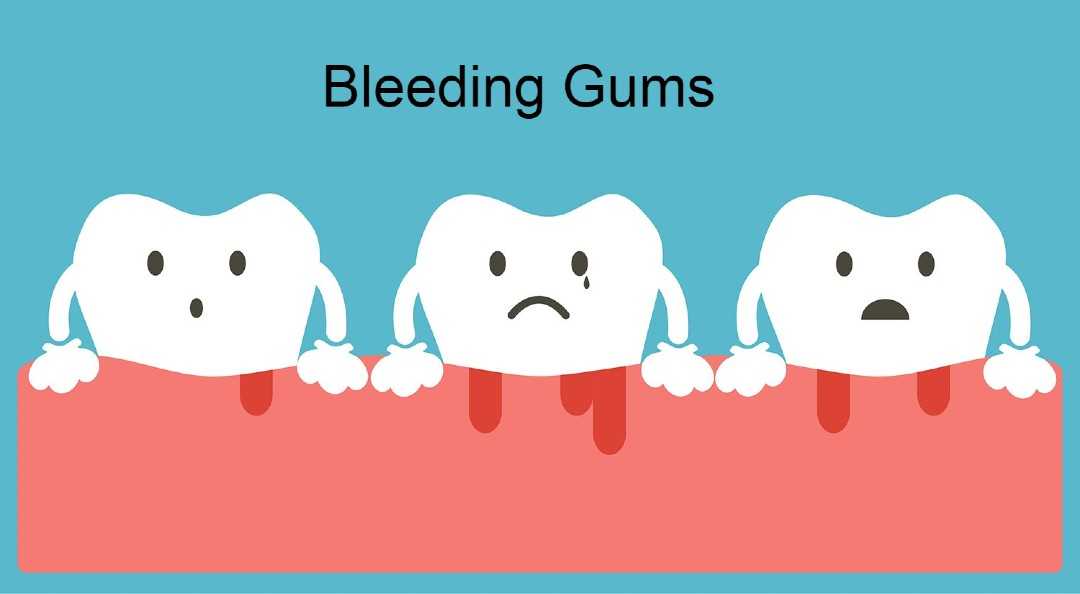Simple tips for bleeding gum treatments