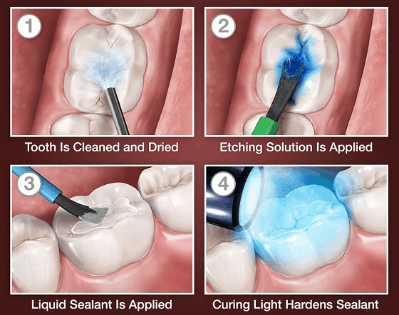 The Essential Guide To Pit And Fissure Sealants