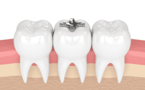 What Is an Amalgam Filling?