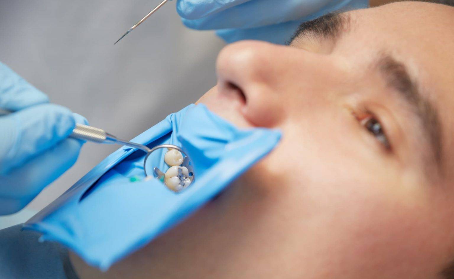 How to Recognize the Risks of Root Canal Treatment