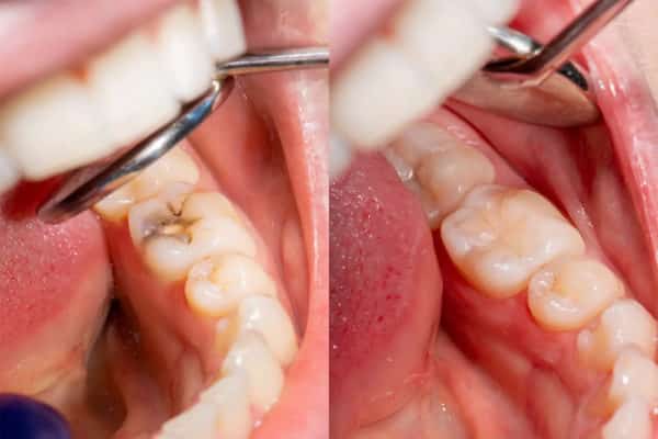 Facts About Dental Fillings You Need to Know