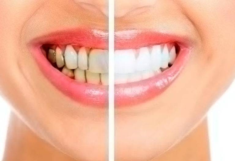 All you need to know about teeth bleaching