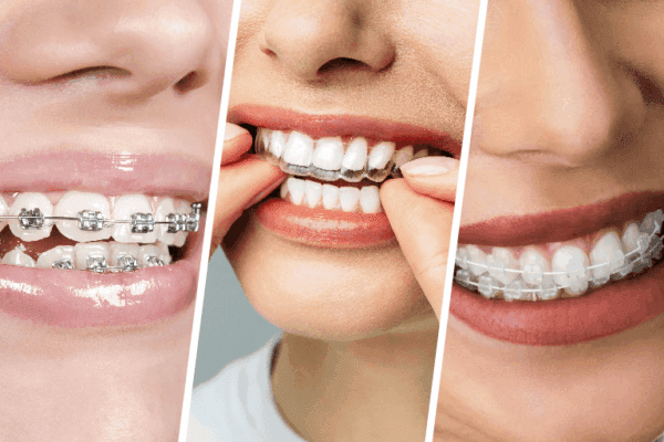 Clear Aligners vs Metal & Ceramic Braces – What’s Best for You? | Sabka Dentist